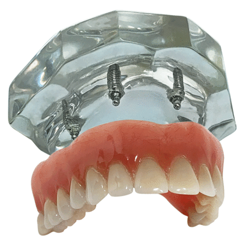 Macro Modelo Overdenture em Acrílico com 4 implantes Oring + Prótese ...